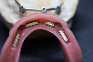 METALODONT Laboratoire de Prothèse Dentaire • VUE-DE-L’INTRADOS-AVEC ...